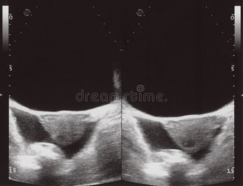 Full Abdomen Ultrasound Sonogram Stock Photo - Image of care ...