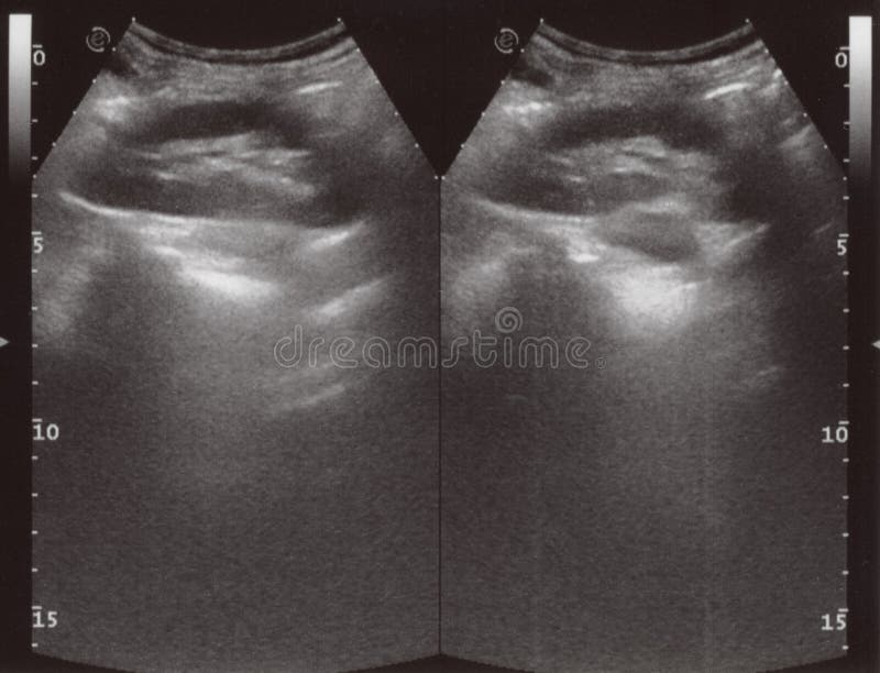 Full Abdomen Ultrasound Sonogram Stock Image - Image of pharmacy ...