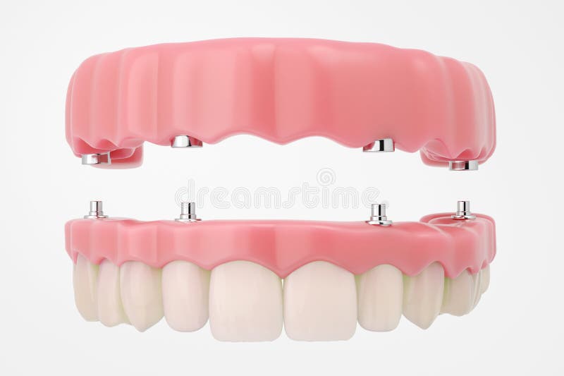 Full Mouth Dental Implant with Screw-supported Denture Stock ...
