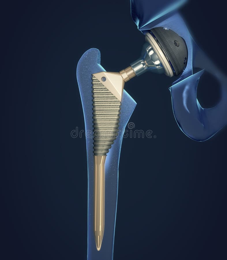 Function of a Hip Joint Implant or Hip Prosthesis in Frontal View Stock ...