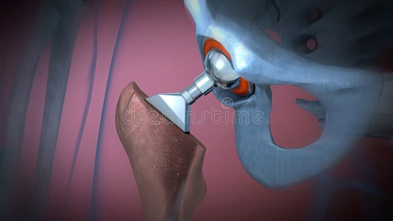 Function of a Hip Joint Implant or Hip Prosthesis in Frontal View Stock ...