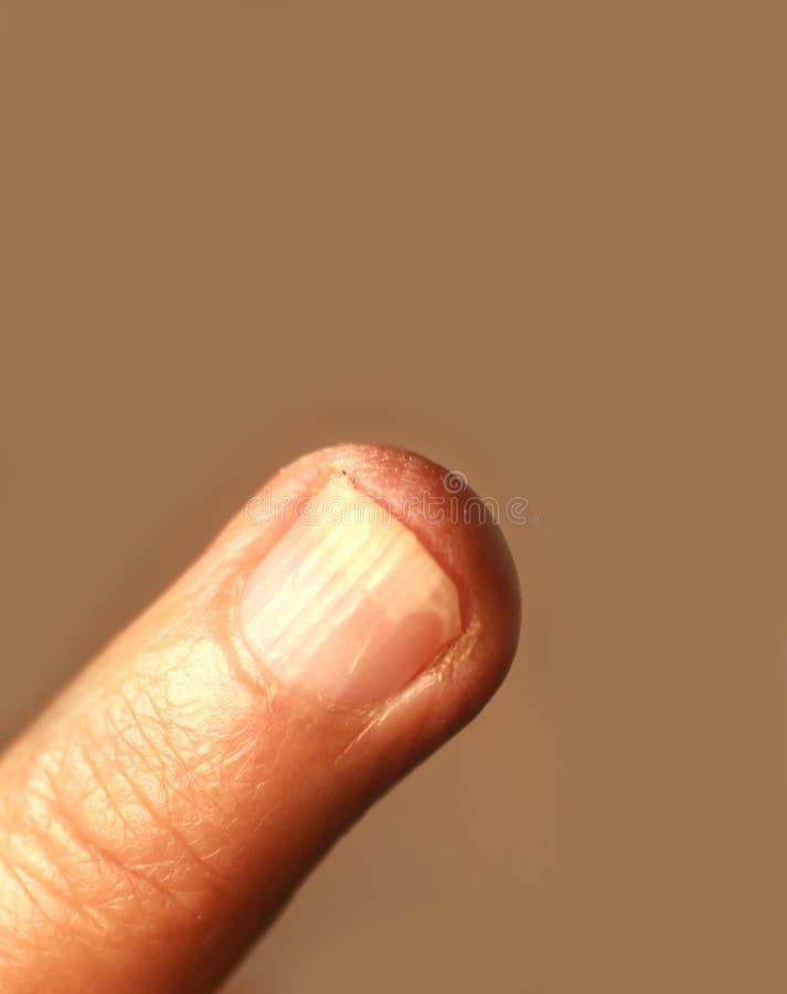 Fungal Infection Under the Nail. a Finger on a Hand with a Fungal ...