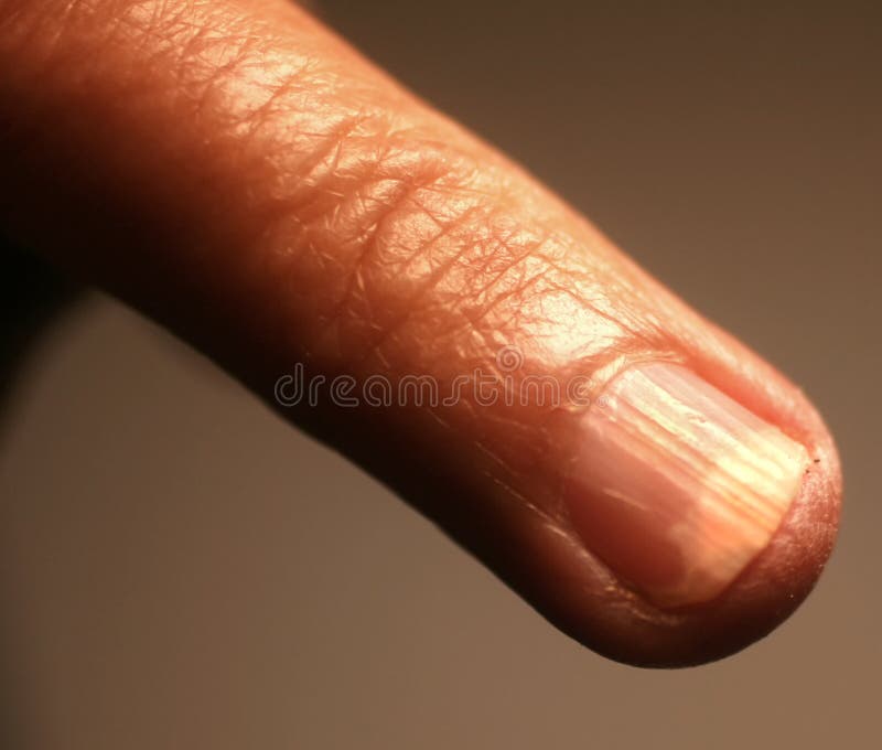 Fungal Infection Under the Nail. a Finger on a Hand with a Fungal ...