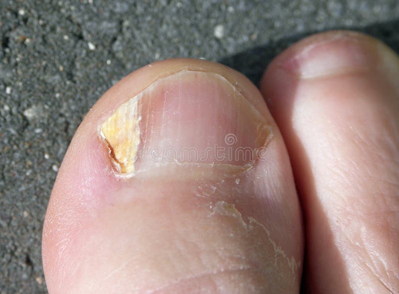 Fungal Nail Infection and Damage on Human Hand. Finger with ...