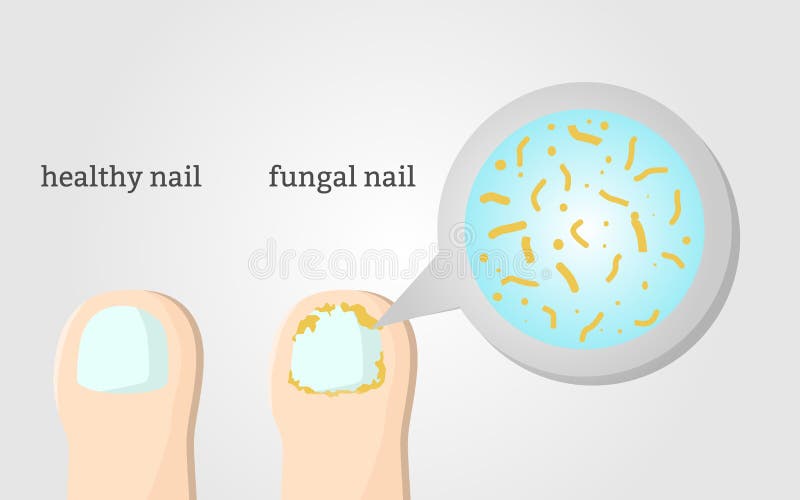 Fungal Nail Infection and Take Care Stock Vector - Illustration of nail ...
