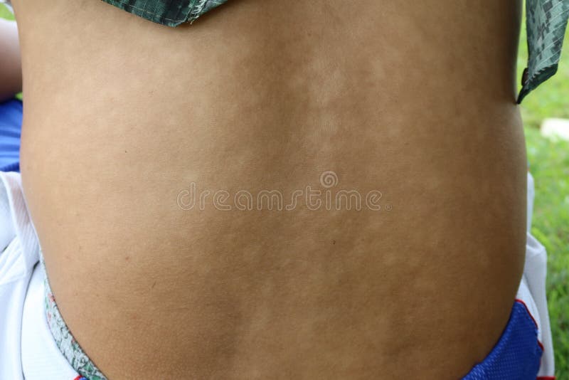 Fungal Ringworm on the Skin on the Back Stock Photo - Image of ringworm ...