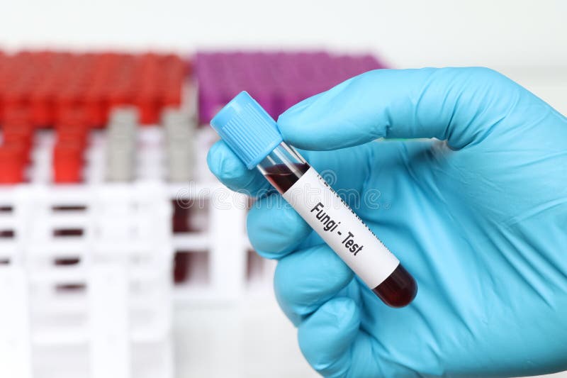 Fungi Test, Blood Sample To Analyze in the Laboratory Stock Image ...