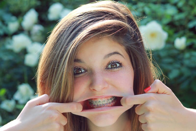 Funny Expression with Braces Stock Photo - Image of silver, teenager ...