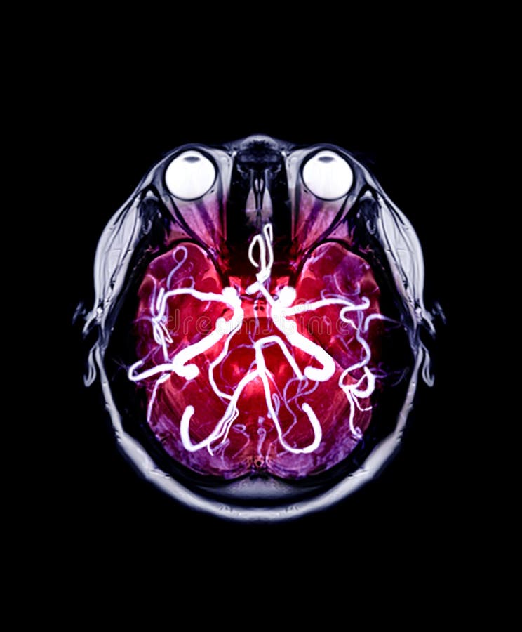Fusion Image of MRI Brain and MRA Brain. Stock Image - Image of ...