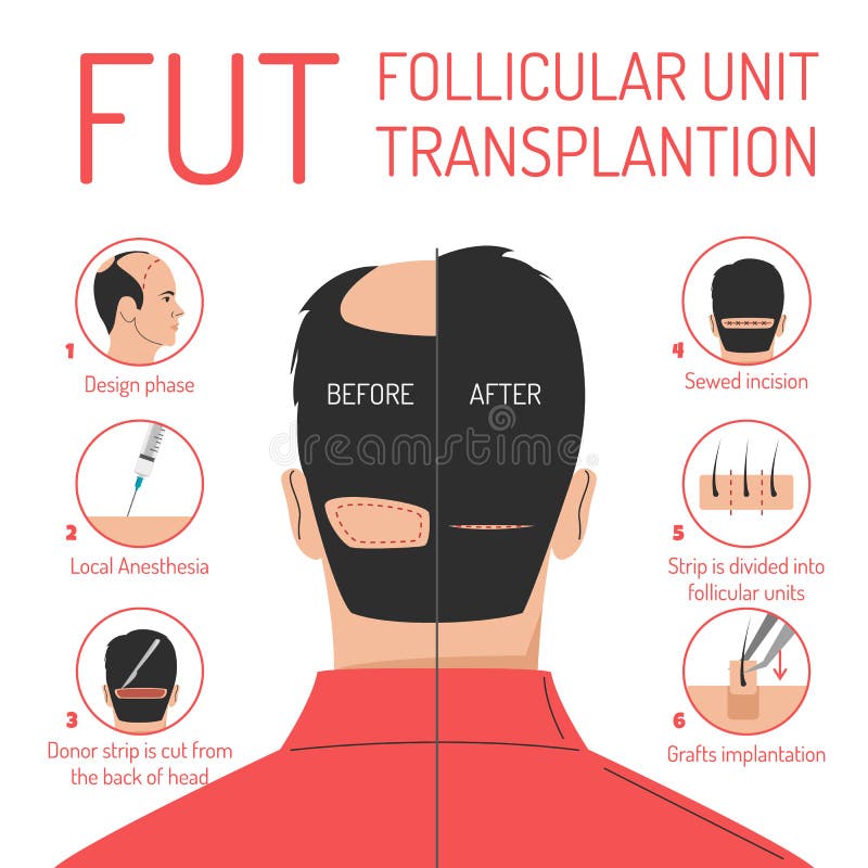 Fut And Fue Hair Transplantation Process Isolated Stock Vector