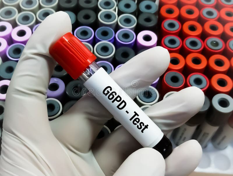 G6PD (glucose 6 Phosphate Dehydrogenase) Test Stock Photo - Image of ...