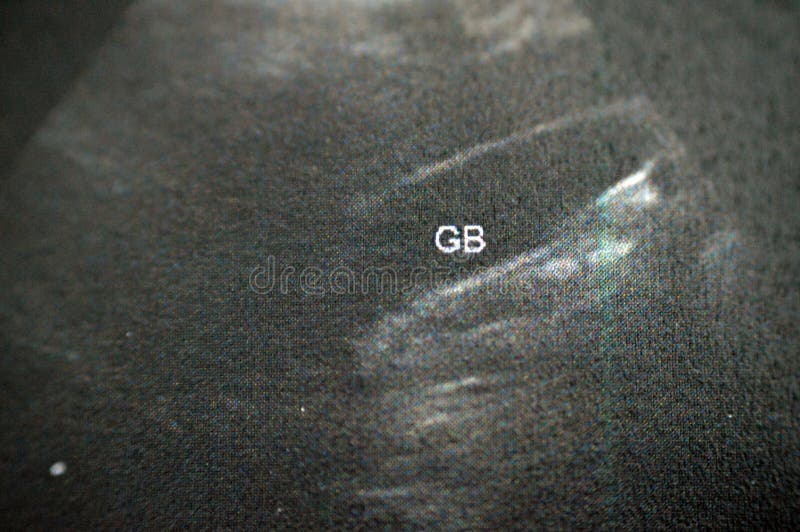 Gall Bladder of Average Size and Normal Wall Thickness, No Stones or ...