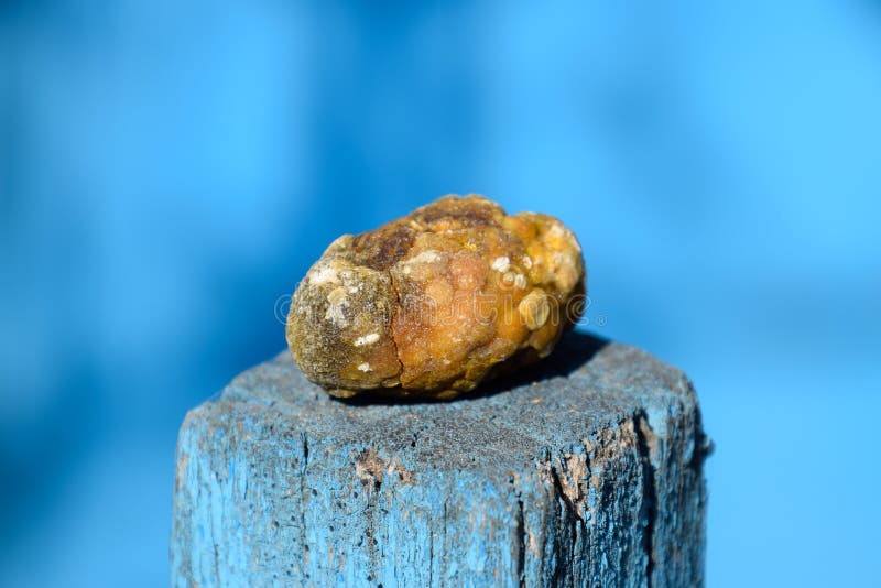 Gall Bladder Stone. Calculus of Heterogeneous Composition Stock Photo ...