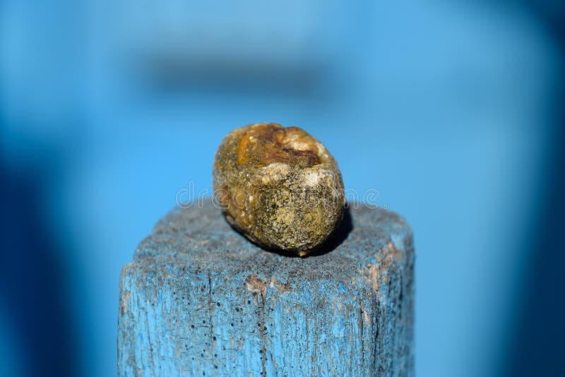 Gall Bladder Stone. Calculus of Heterogeneous Composition Stock Photo ...