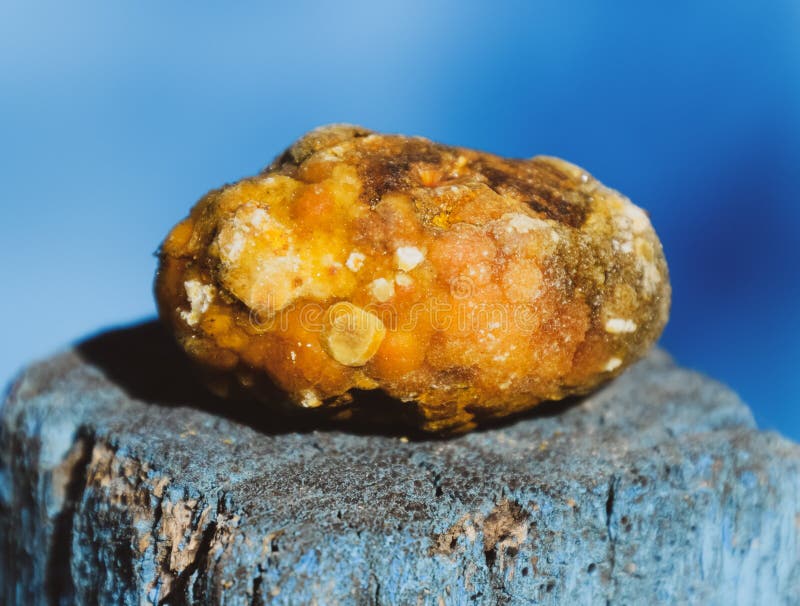 Gall Bladder Stone. Calculus of Heterogeneous Composition Stock Image ...