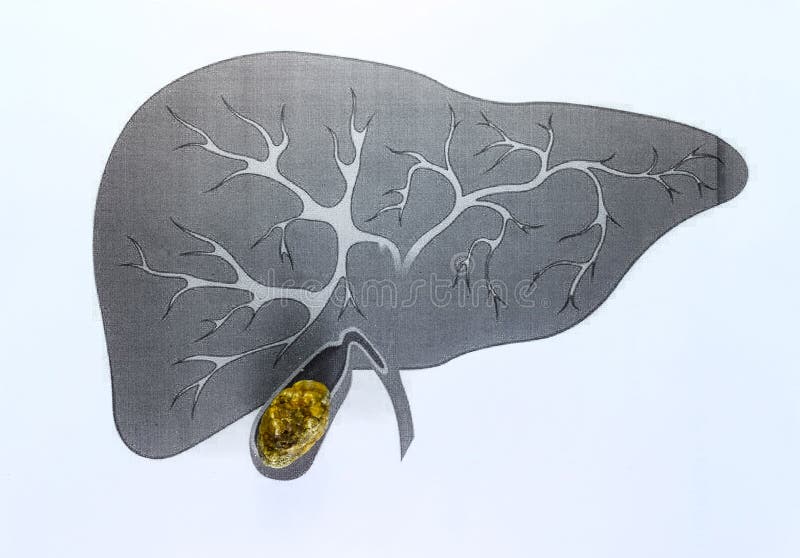 Gall Bladder Stone, Schematic Depiction, Large Sized Gallstone, Result ...