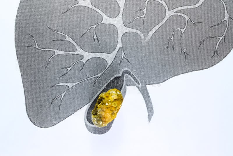 Gall Bladder Stone, Schematic Depiction, Large Sized Gallstone, Result ...