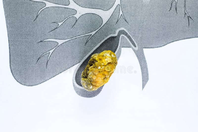 Large Gallstone, Gall Bladder Stone. the Result of Gallstones Stock ...