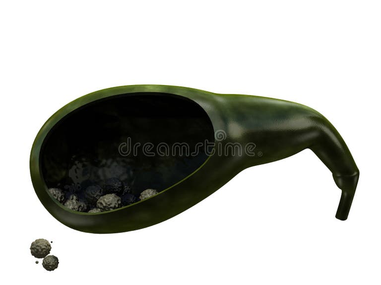 Gallbladder Stones Stock Illustrations – 219 Gallbladder Stones Stock ...