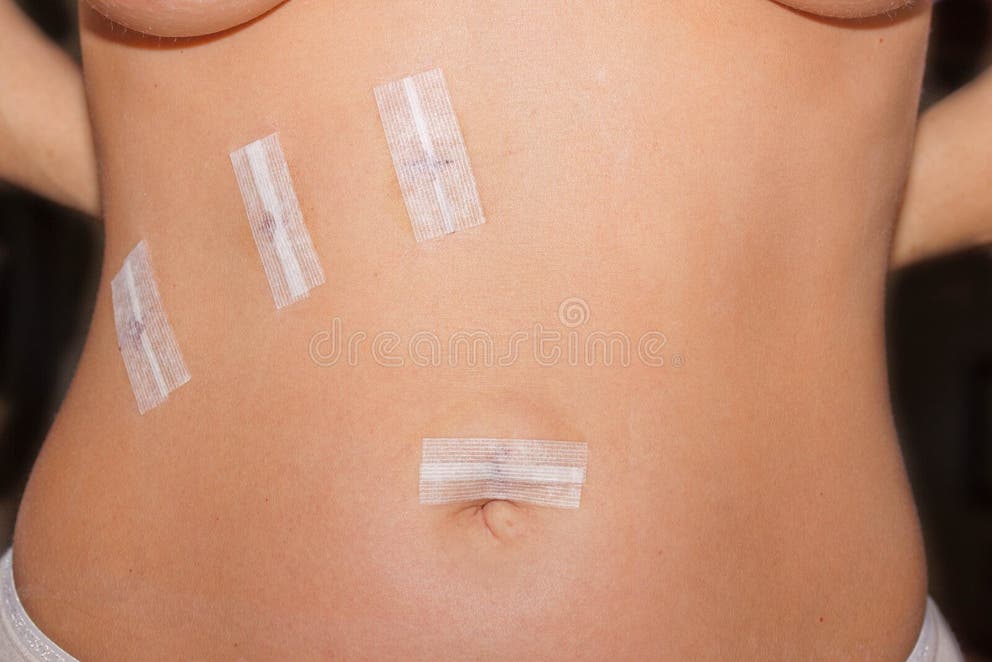 Gall Bladder Surgery stock image. Image of stitches, operation - 15245253