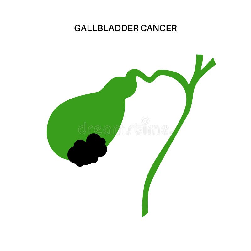 Gallbladder Test Stock Illustrations – 92 Gallbladder Test Stock ...