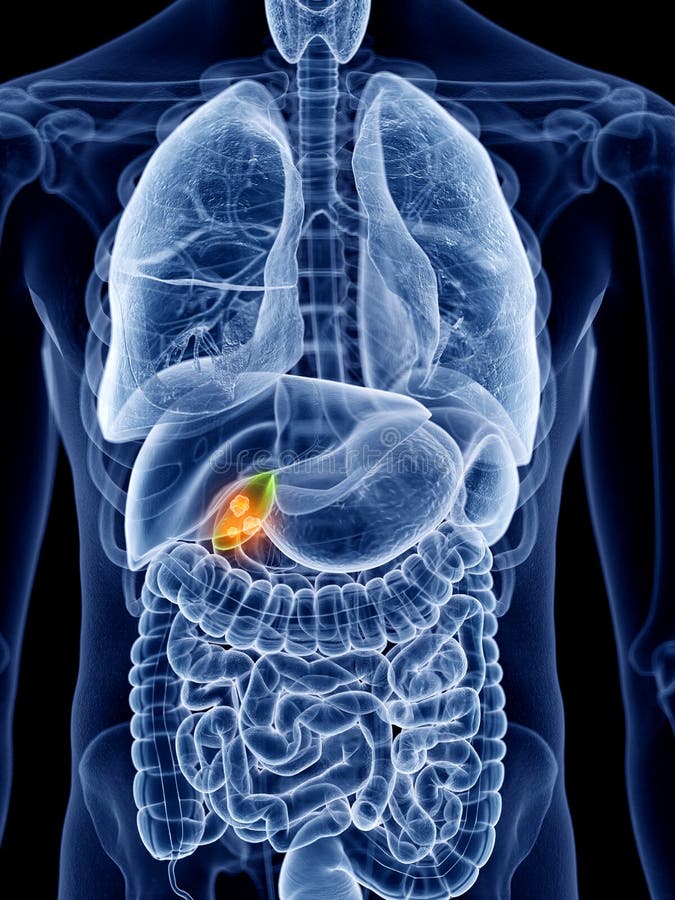 Gallbladder cancer stock illustration. Illustration of artwork - 73539866