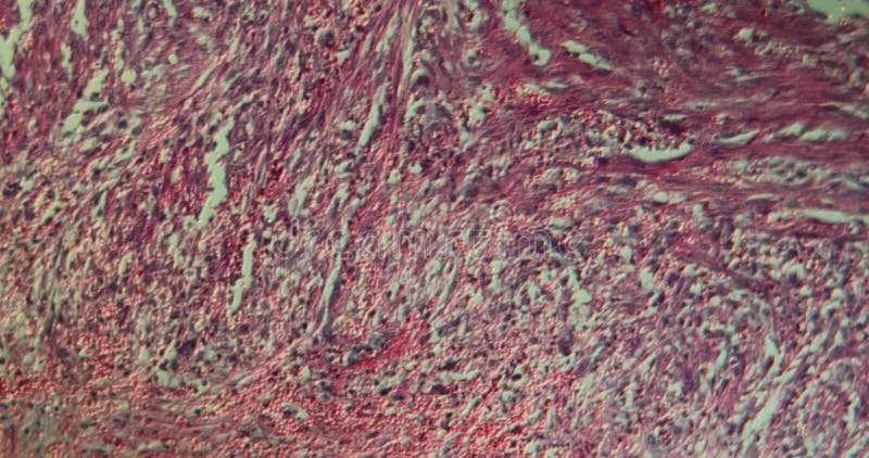 Gallbladder Necrosis Tissue Stock Footage - Video of magnification ...