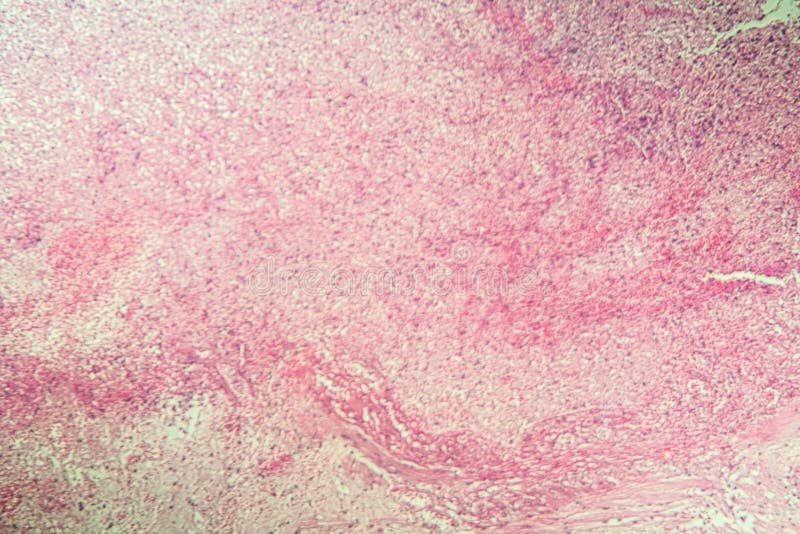 Gallbladder Necrosis Tissue Stock Image - Image of investigation ...