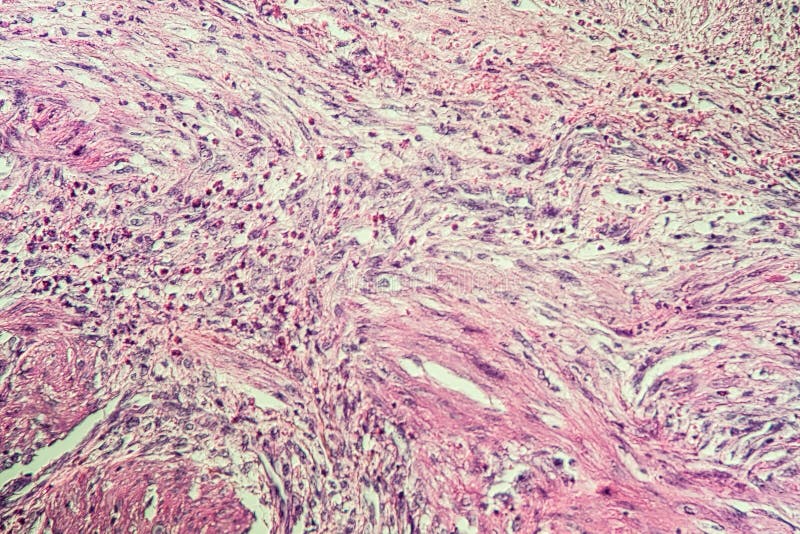 Gallbladder Necrosis Tissue Under the Microscope Stock Photo - Image of ...