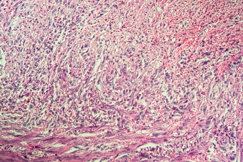 Gallbladder Necrosis Tissue Under the Microscope Stock Photo - Image of ...