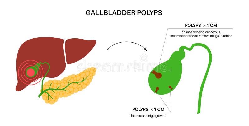 Gallbladder polyp anatomy stock vector. Illustration of surgery - 252201283