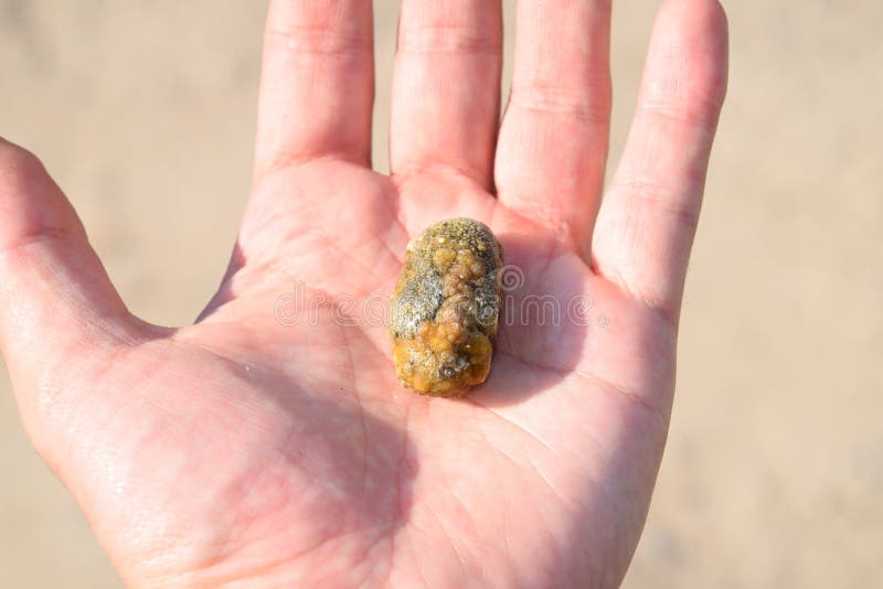 Real Gallbladder Stones