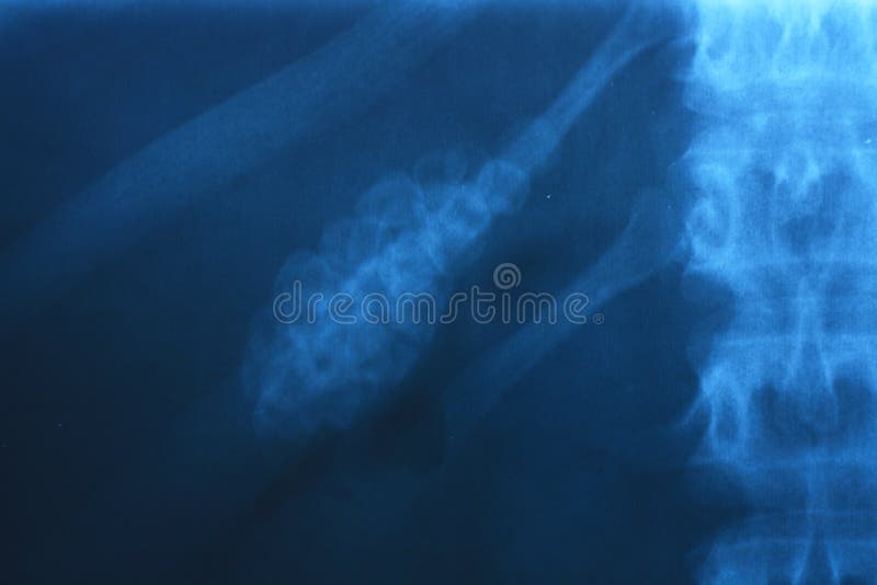 618 Gallstones Stock Photos - Free & Royalty-Free Stock Photos from ...