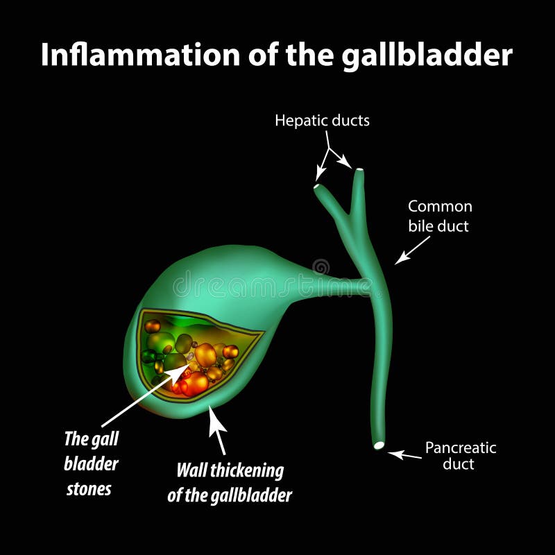 Gallstones. Cholelithiasis. Cholecystitis. Inflammation of the ...