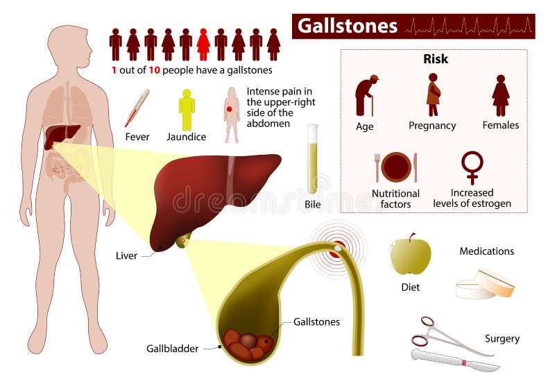 Gallstones Medische Infographic Vector Illustratie - Illustration of ...