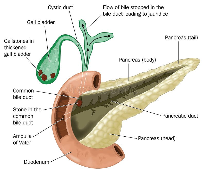 Galstenen in gallbladder stock illustratie. Illustration of blaas ...
