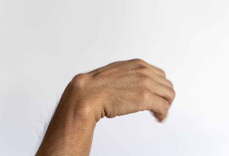 Ganglion Cyst on Man& X27;s Hand on White Background Stock Image ...