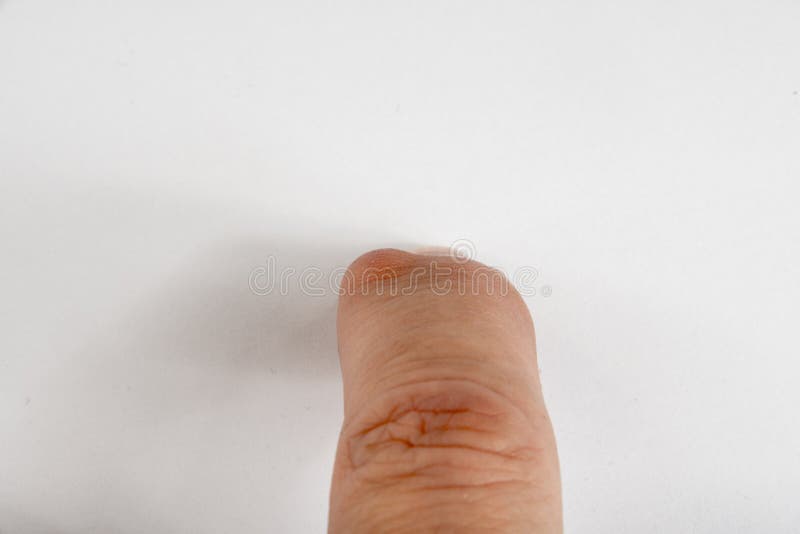 Guzek ganglionowy na palcu zdjęcie stock. Obraz złożonej z odosobniony ...