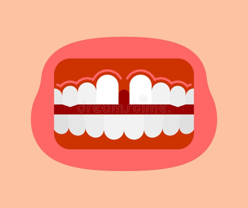 Gap Mouth. Large Space between Teeth Stock Vector - Illustration of ...