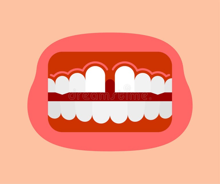 Gap Mouth. Large Space between Teeth Stock Vector - Illustration of ...