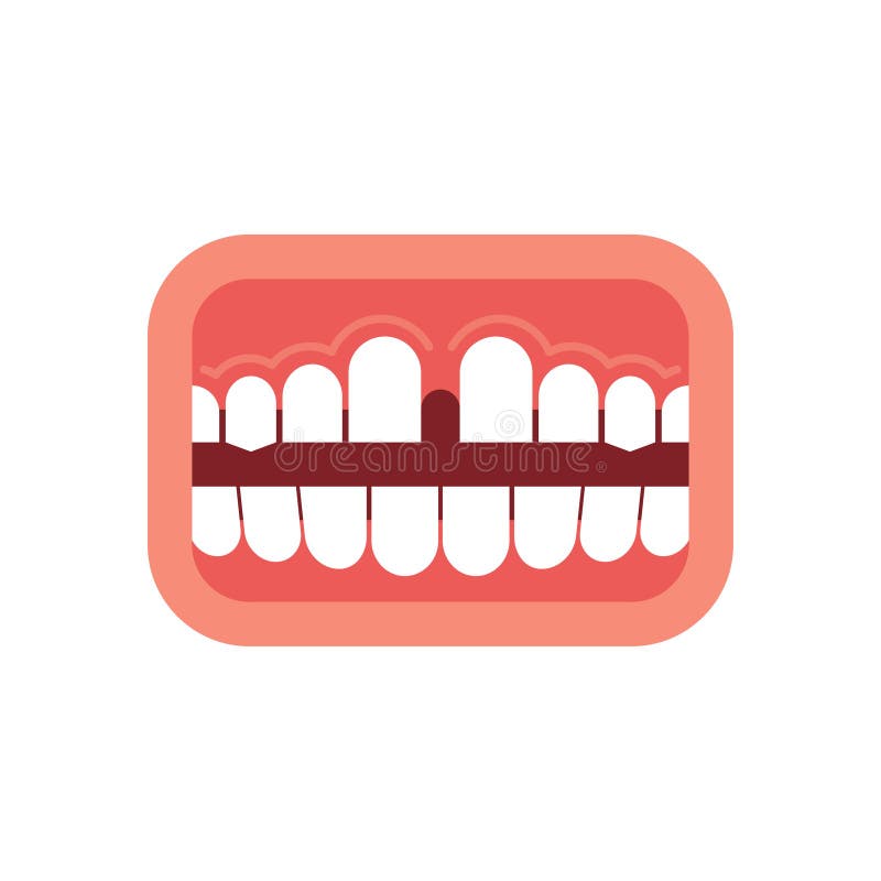 Gap Mouth. Large Space between Teeth Stock Vector - Illustration of ...
