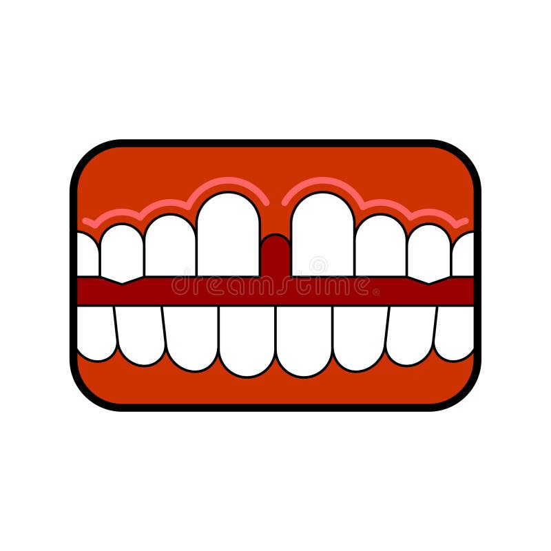 Teeth Gap Cartoon Stock Illustrations – 153 Teeth Gap Cartoon Stock ...