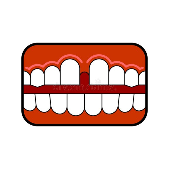 Teeth Gap Cartoon Stock Illustrations – 153 Teeth Gap Cartoon Stock ...