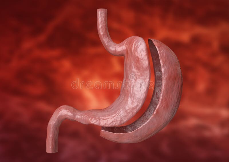 Gastrectomia Verticale Della Manica Chirurgia Di Bariatric Con ... Gastrectomia Verticale Della Manica Chirurgia Di Bariatric Con ...