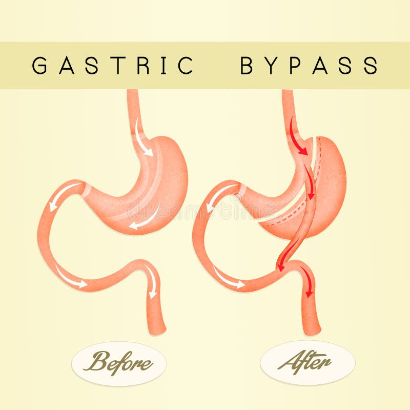 Before and after Gastric Bypass Surgery Stock Illustration ...