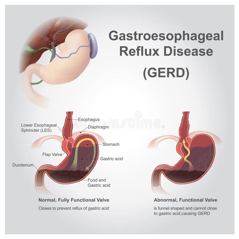 Esquema Del Diagrama De La Enfermedad Del Reflujo Gastroesofágico ...