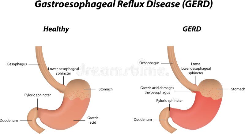 Gastroesophageal Reflux Disease Stock Vector - Illustration of body ...