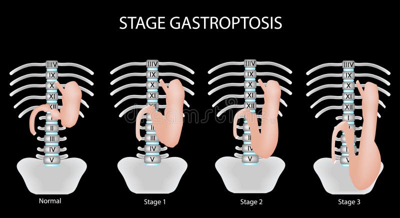 Gastroptosis Stomach. the Omission of the Stomach. Stage Gastroptosis ...