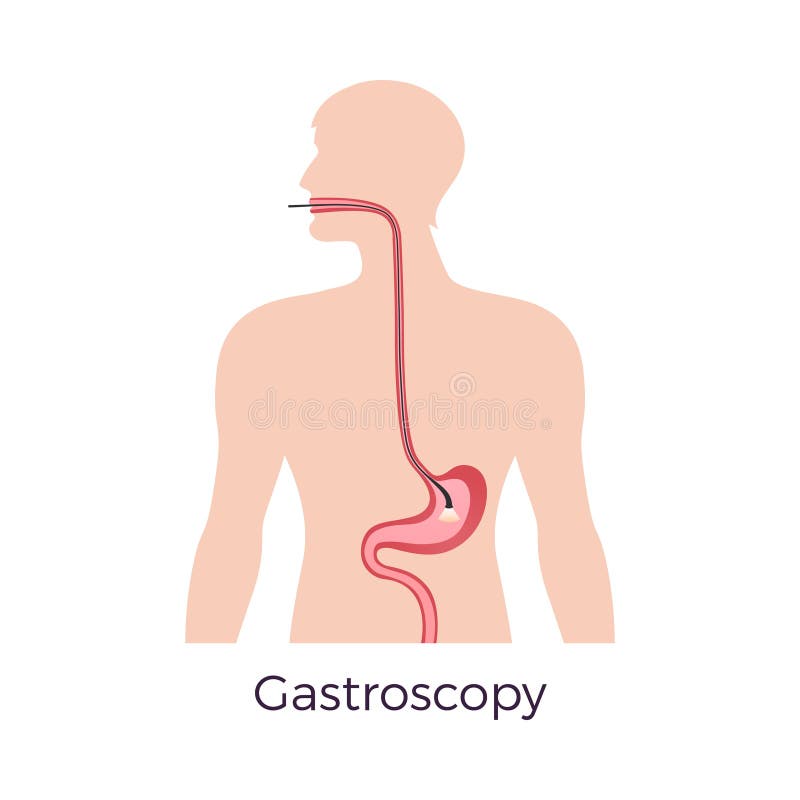 Gastroscopy Flat Concept stock vector. Illustration of intestinal ...