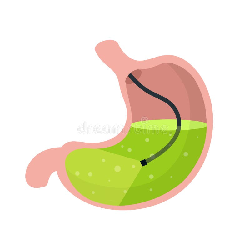 Gastroscopy. Endoscopy and Digestive Problems. Hose with Camera Stock ...